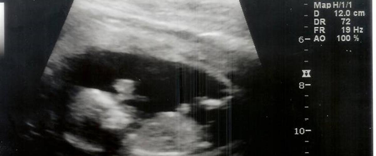 Scanningsbilleder af Kasper :0) - Graviditet - Uploadet af Camilla